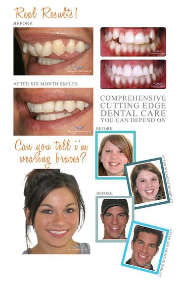 6 Month Smiles | Town Dental